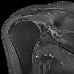 Capsulite Adesiva: O que é, Causas, Sintomas, Tratamentos e Cirurgias ...