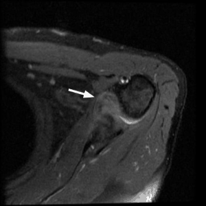 Capsulite Adesiva: O que é, Causas, Sintomas, Tratamentos e Cirurgias ...